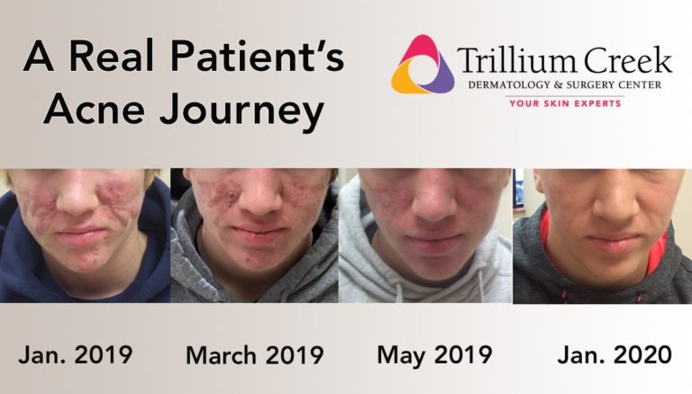Accutane Near Me Ohio | Trillium Creek Dermatology