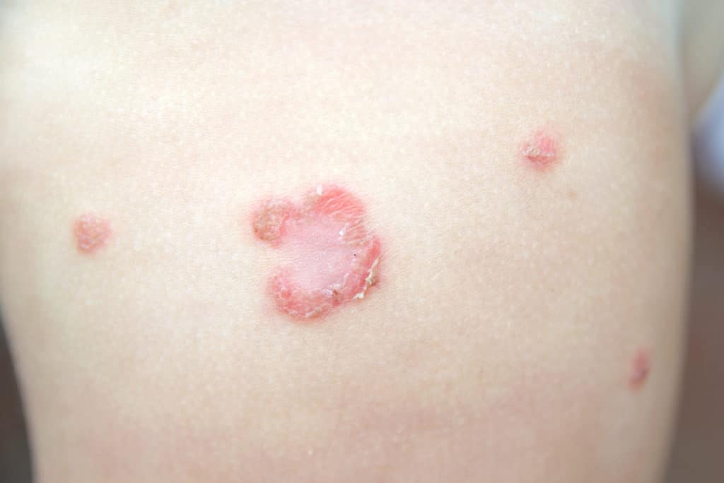 Common Skin Infections for Wrestlers - Trillium Creek Dermatology